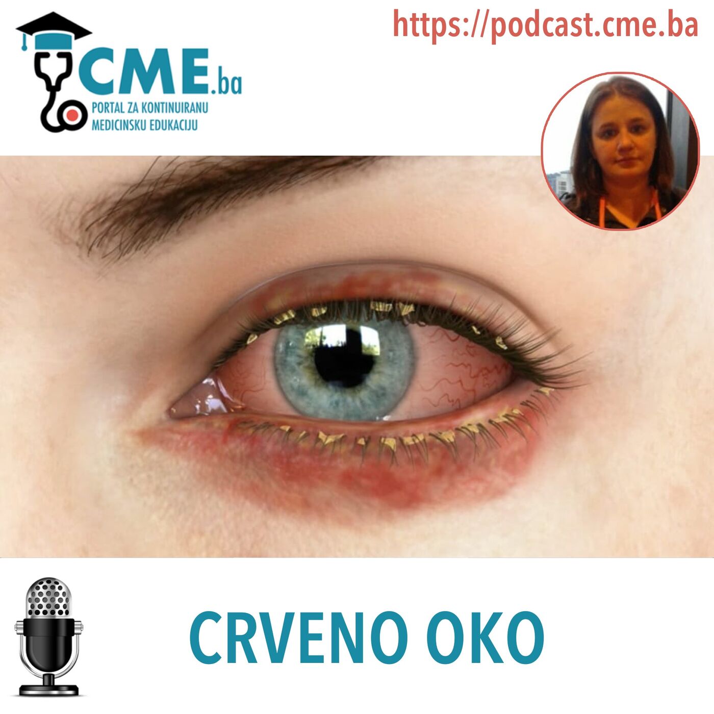 Crveno oko – CME.ba